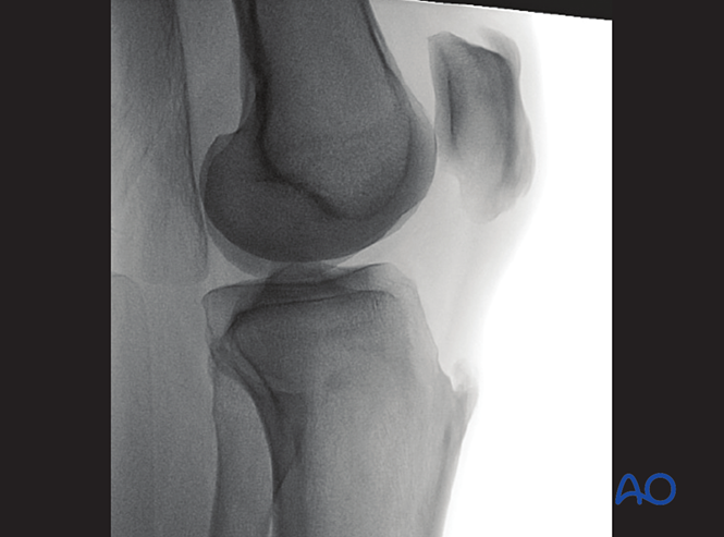 Intraoperative imaging of the proximal tibia