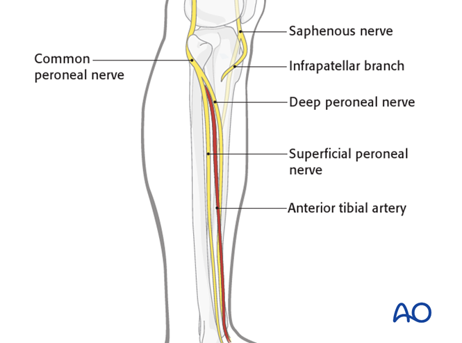Safe zones in the tibia for pin placement