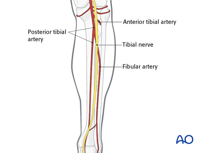 Safe zones in the tibia for pin placement