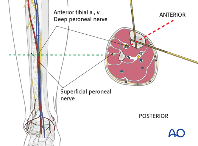 Safe zones in the tibia for pin placement