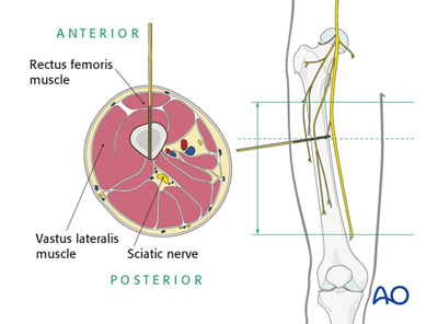 Safe zones in the tibia for pin placement