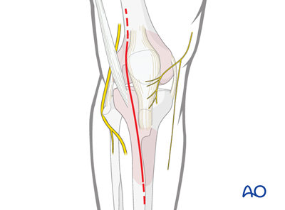 Anterolateral approach to the proximal tibia