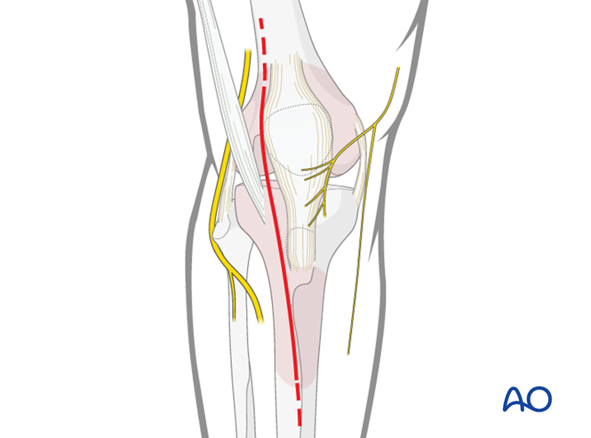 Anterolateral approach to the proximal tibia