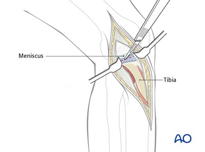 Anterolateral approach to the proximal tibia