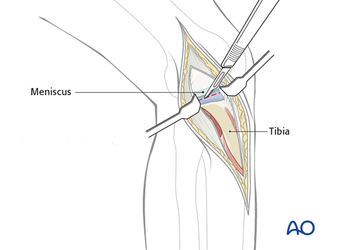 Anterolateral approach to the proximal tibia