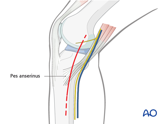 Medial/posteromedial approach to the proximal tibia