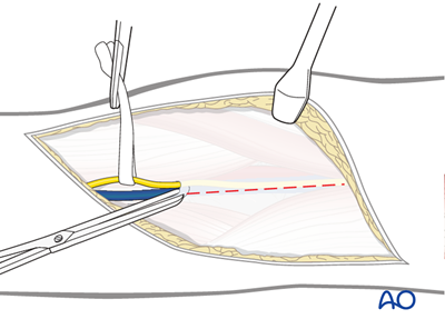 Posterior approach to the proximal tibia