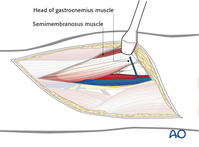 Posterior approach to the proximal tibia