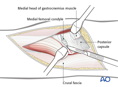 Posterior approach to the proximal tibia