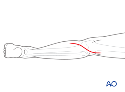 Posterior approach to the proximal tibia