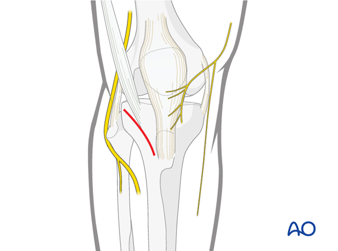 Approach for minimally invasive osteosynthesis (MIO) of the proximal tibia