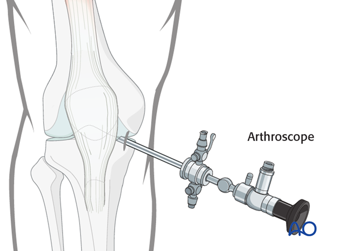 Approach for minimally invasive osteosynthesis (MIO) of the proximal tibia