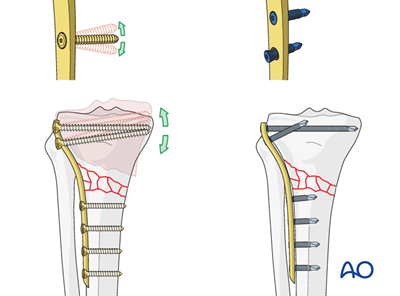 MIO - Angular stable plate (LISS) for Complete articular fracture ...