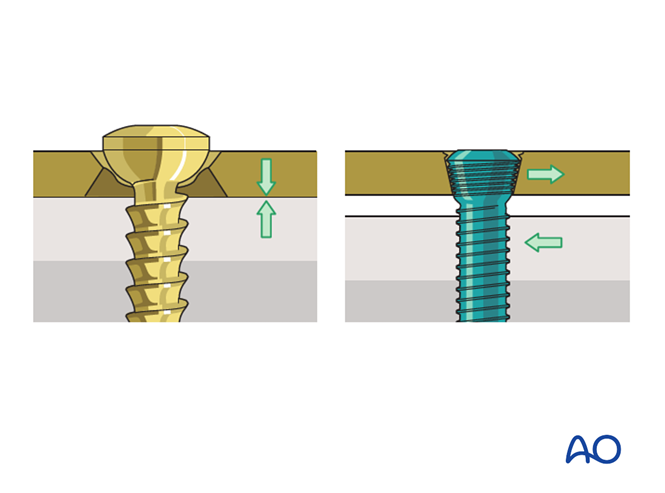 MIO - Angular stable plate (LISS) for Complete articular fracture ...