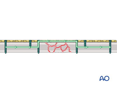 MIO - Angular stable plate (LISS) for Extraarticular fracture ...