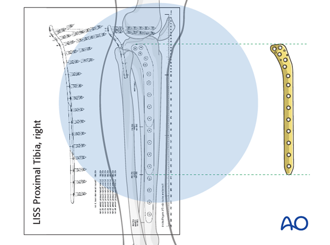MIO - Angular stable plate (LISS) for Extraarticular fracture ...