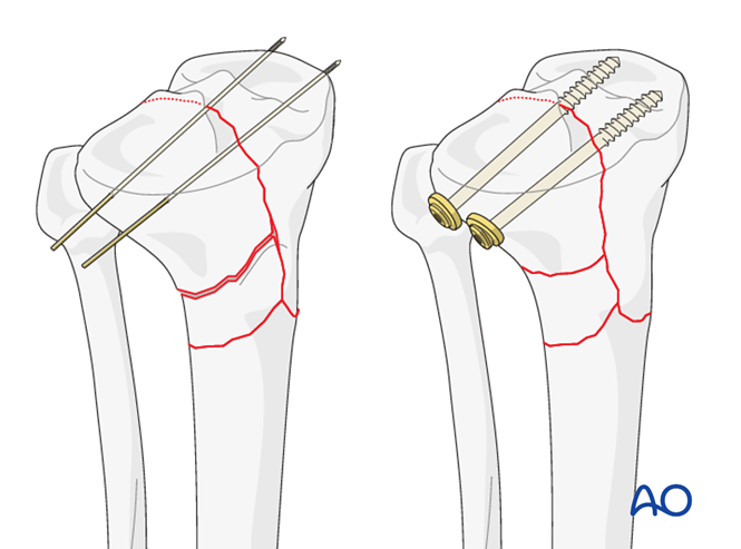 MIO - Angular stable plate (LISS) for Complete articular fracture ...