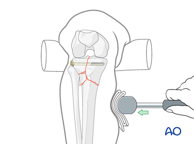 MIO - Angular stable plate (LISS) for Complete articular fracture ...