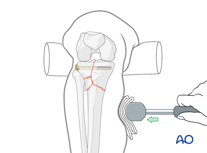 MIO - Angular stable plate (LISS) for Complete articular fracture ...