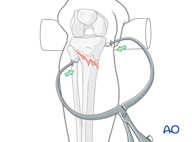 MIO - Angular stable plate (LISS) for Extraarticular fracture ...
