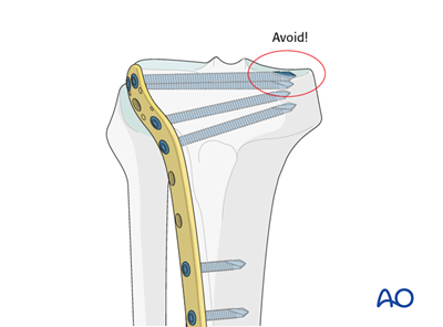 MIO - Angular stable plate (LISS) for Complete articular fracture ...