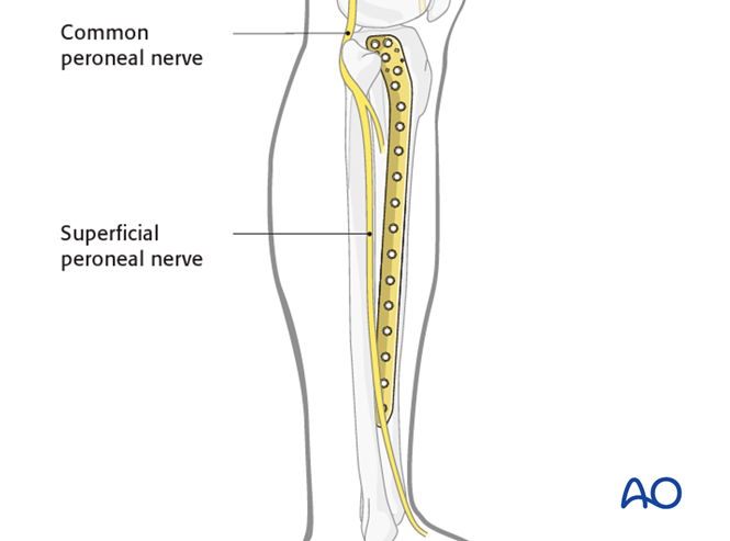 MIO - Angular stable plate (LISS) for Complete articular fracture ...