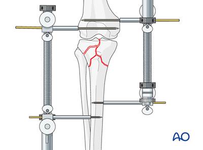 MIO - Angular stable plate (LISS) for Complete articular fracture ...