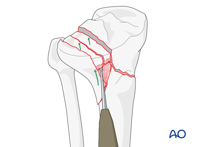 MIO - Angular stable plate (LISS) for Complete articular fracture ...
