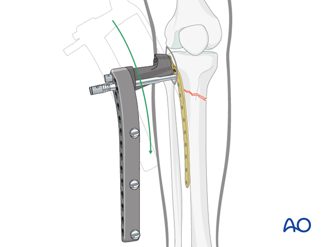 MIO - Angular stable plate (LISS) for Extraarticular fracture ...