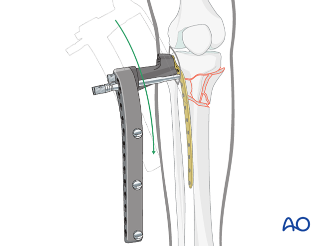 MIO - Angular stable plate (LISS) for Extraarticular fracture ...