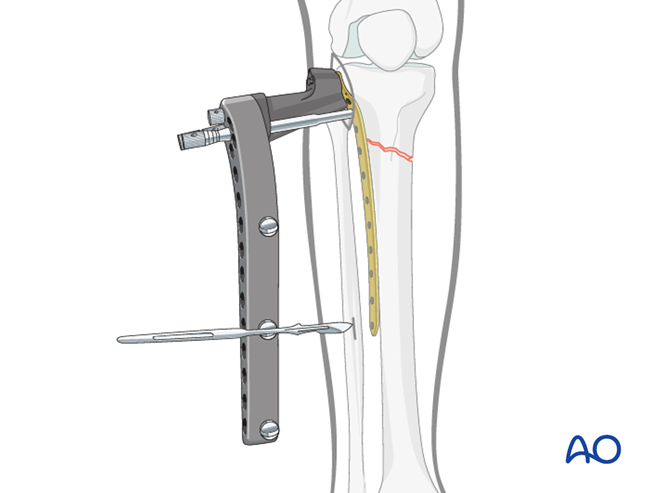 MIO - Angular stable plate (LISS) for Extraarticular fracture ...
