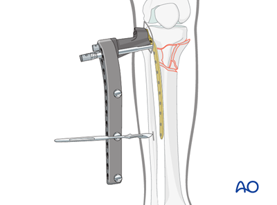 MIO - Angular stable plate (LISS) for Extraarticular fracture ...