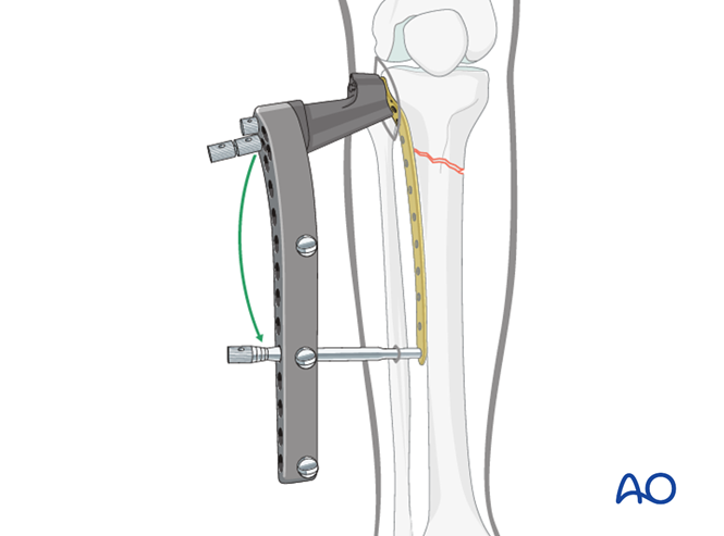 MIO - Angular stable plate (LISS) for Extraarticular fracture ...