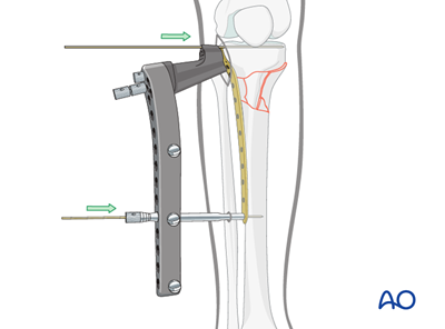 MIO - Angular stable plate (LISS) for Extraarticular fracture ...