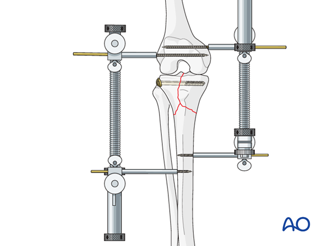 MIO - Angular stable plate (LISS) for Complete articular fracture ...