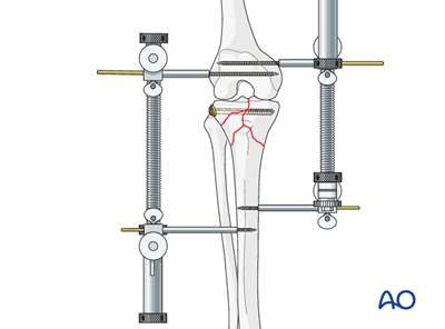 MIO - Angular stable plate (LISS) for Complete articular fracture ...