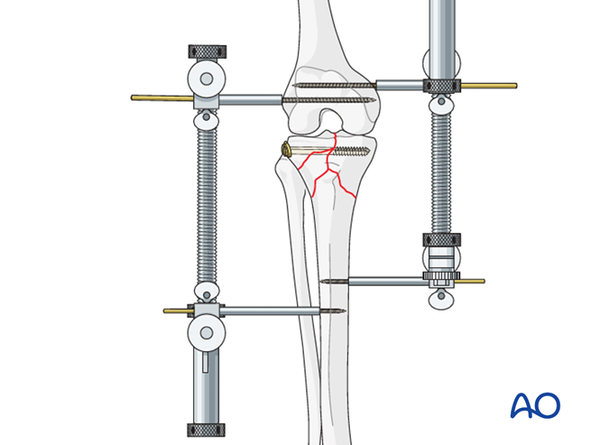 MIO - Angular stable plate (LISS) for Complete articular fracture ...