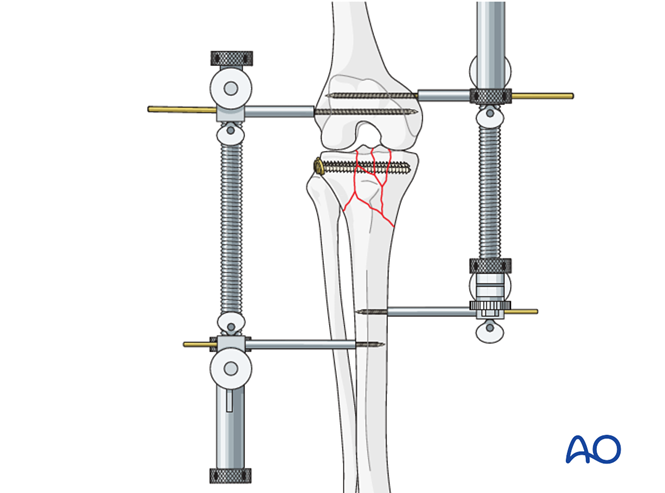 MIO - Angular stable plate (LISS) for Complete articular fracture ...