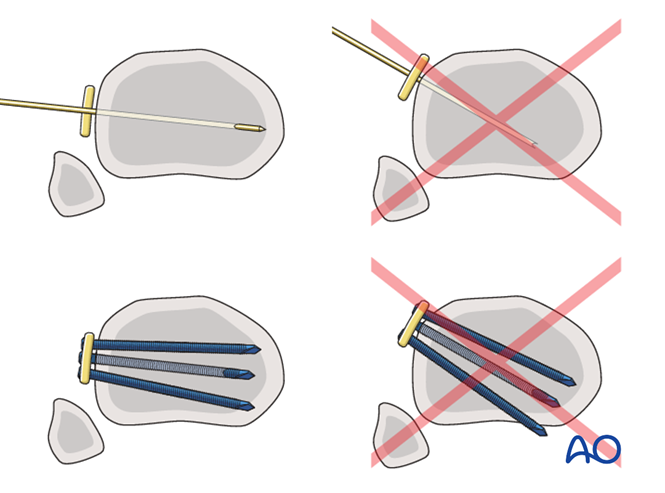 MIO - Angular stable plate (LISS) for Extraarticular fracture ...