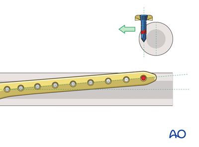 MIO - Angular stable plate (LISS) for Extraarticular fracture ...
