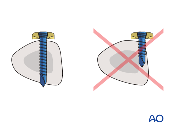 MIO - Angular stable plate (LISS) for Extraarticular fracture ...