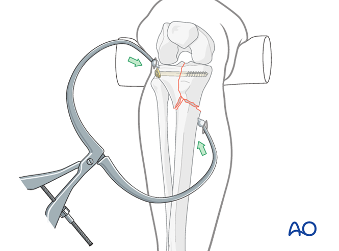 MIO - Angular stable plate (LISS) for Complete articular fracture ...