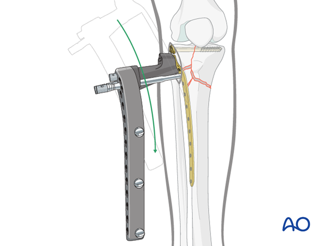 MIO - Angular stable plate (LISS) for Complete articular fracture ...