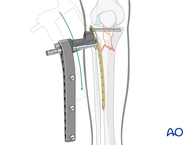 MIO - Angular stable plate (LISS) for Complete articular fracture ...