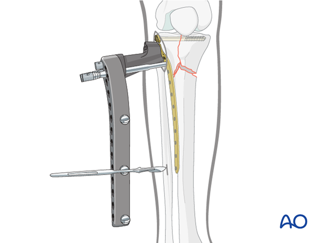 MIO - Angular stable plate (LISS) for Complete articular fracture ...