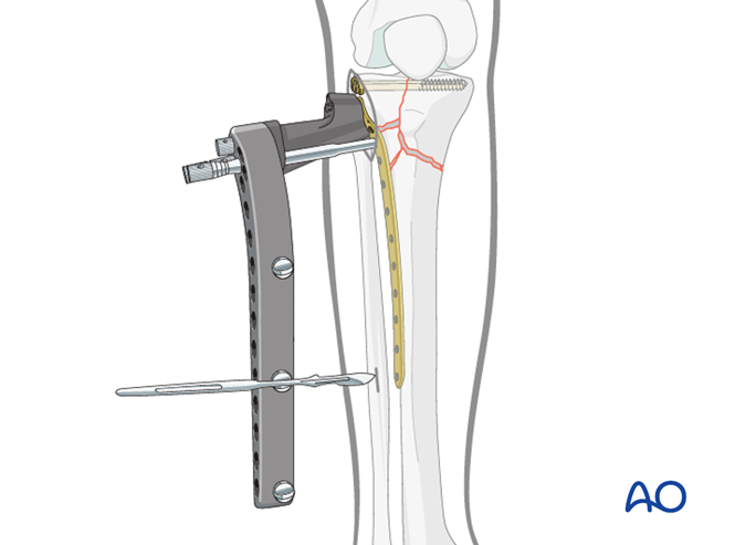 MIO - Angular stable plate (LISS) for Complete articular fracture ...