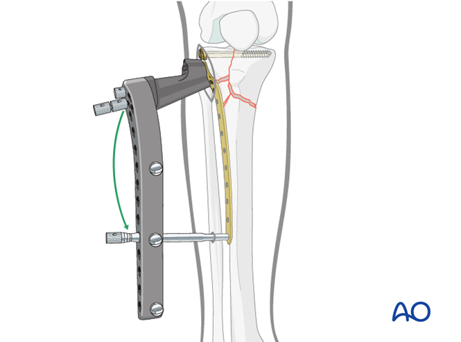 MIO - Angular stable plate (LISS) for Complete articular fracture ...