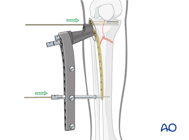 MIO - Angular stable plate (LISS) for Complete articular fracture ...