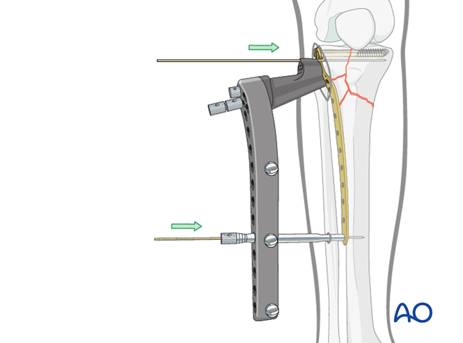 MIO - Angular stable plate (LISS) for Complete articular fracture ...