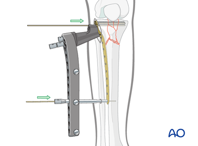 MIO - Angular stable plate (LISS) for Complete articular fracture ...